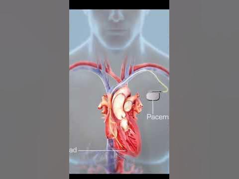 Pacemakers explained,How Pacemaker Implanted #shorts - YouTube