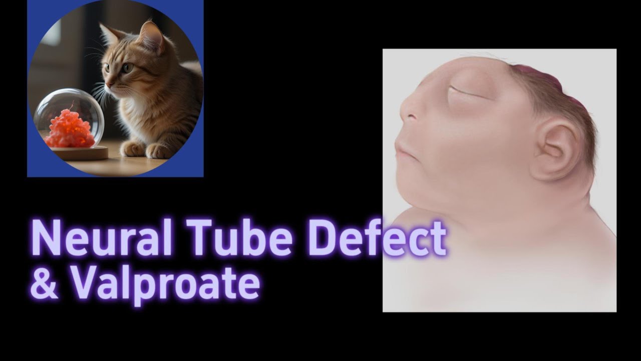 𝗡𝗲𝘂𝗿𝗮𝗹 𝗧𝘂𝗯𝗲 𝗗𝗲𝗳𝗲𝗰𝘁 - 𝗔𝗻𝗲𝗻𝗰𝗲𝗽𝗵𝗮𝗹𝘆 - 𝗨𝗦𝗠𝗟𝗘 𝘀𝘁𝗲𝗽 𝟭, 𝗨𝗪𝗼𝗿𝗹𝗱 𝗤𝘂𝗲𝘀𝘁𝗶𝗼𝗻𝘀 ...