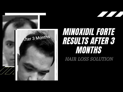 Minoxidil Regroe Forte 6% | Results After 3 months | Hair Loss Solution ...