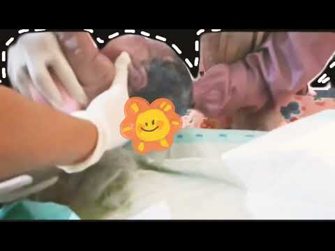 Proses Bayi Meluncur saat Posisi Persalinan Menungging