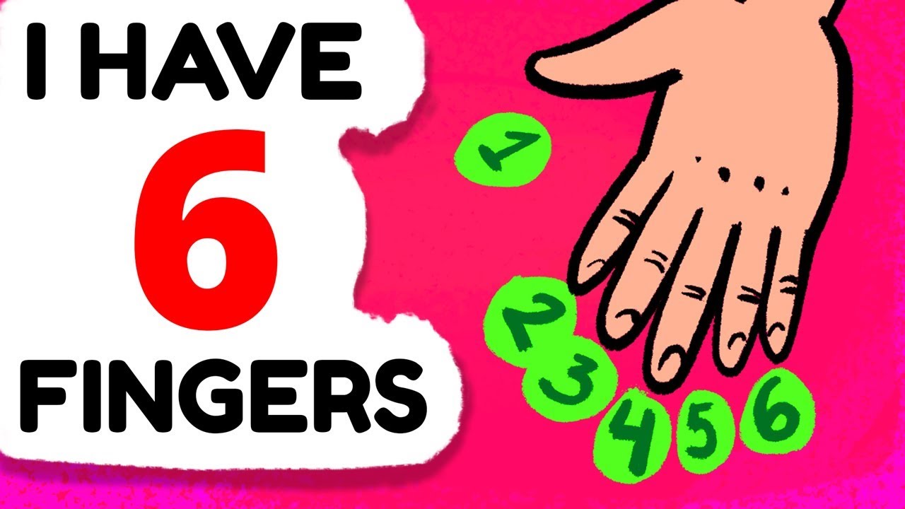 I Have Hexadactyly Which Means 6 Fingers On My Hand - YouTube