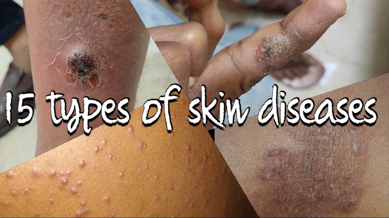 Different Types of Skin Disease - YouTube
