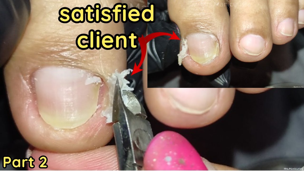 Vlog 1136|Dry Skin/Ingrown Removal| PEDICURE 1036 - YouTube