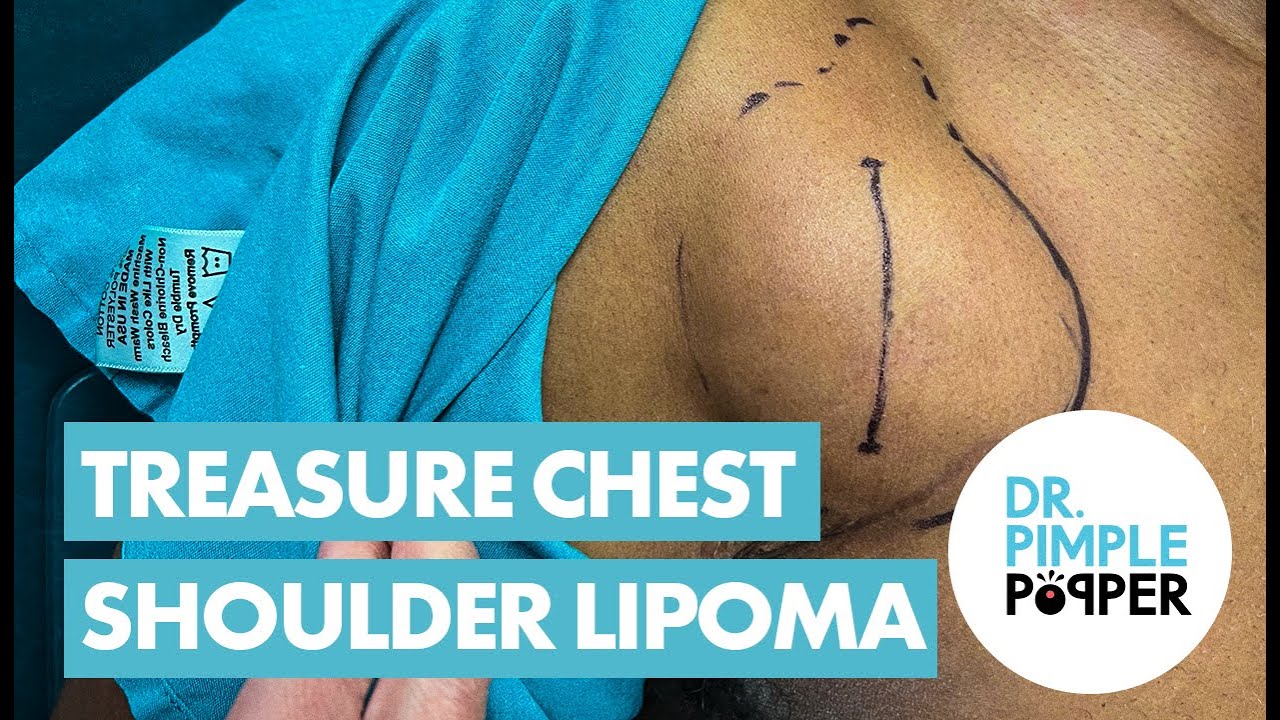 Dr Pimple Popper Satisfies Patient By Opening Treasure Chest - YouTube