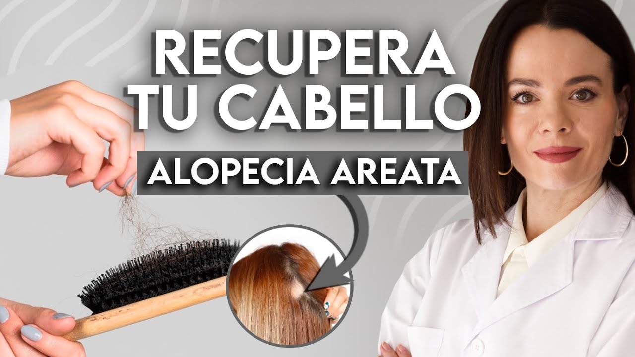 Alopecia Areata 👩🏻‍⚕️ Farmacéutica Especialista Explica Síntomas y ...