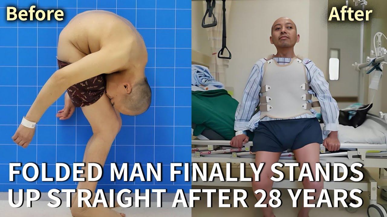 'Folded Man' Finally Stands Up Straight After 28 Years: Surgery Broke ...