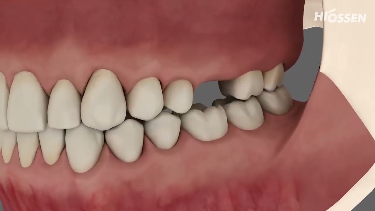 [OSSTEM] HIOSSEN CAS Kit Crestal Approach Sinus Kit - YouTube