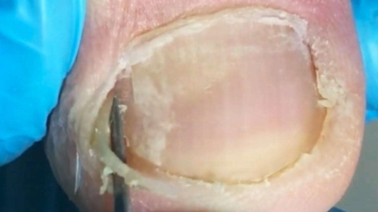 Small toenails, cleaned and trimmed #Pedicure - YouTube