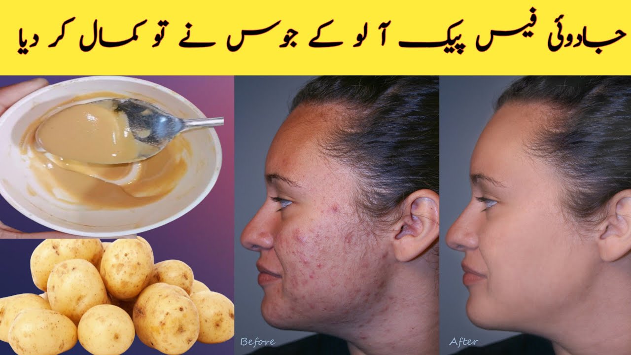 Pigmentation,acne scars,clear skin|Patato face pack for white bright ...