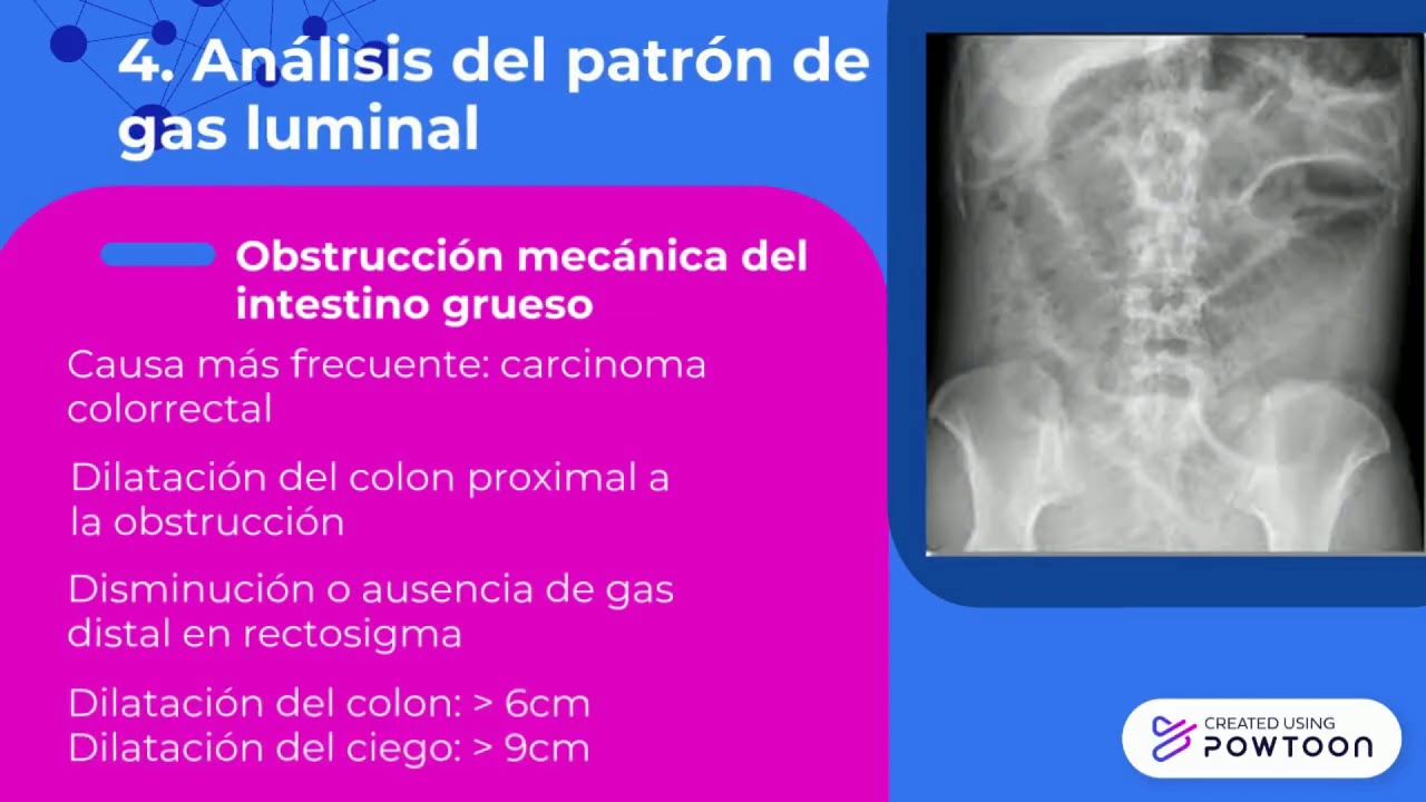 GRUPO 5- Radiología abdominal y signos radiológicos - YouTube