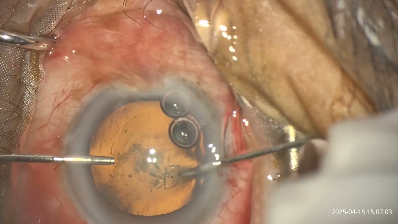 Eyevis EOM 1 Ophthalmic Surgical Microscope surgery video - YouTube