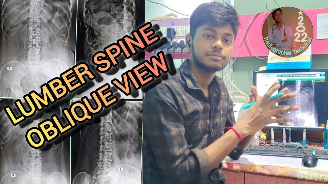 LUMBER SPINE X-RAY || OBLIQUE VIEW || AP VIEW || LATERAL VIEW ...