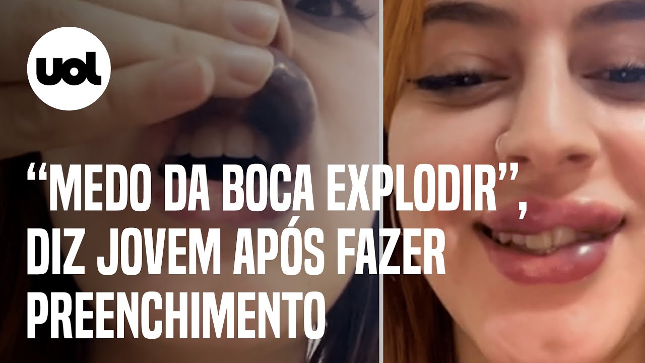 Preenchimento labial gera complicação e viraliza: 'Medo da boca ...