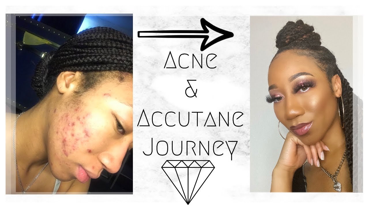 |Acne and Accutane Journey| BEFORE and AFTER PICTURES!!! - YouTube