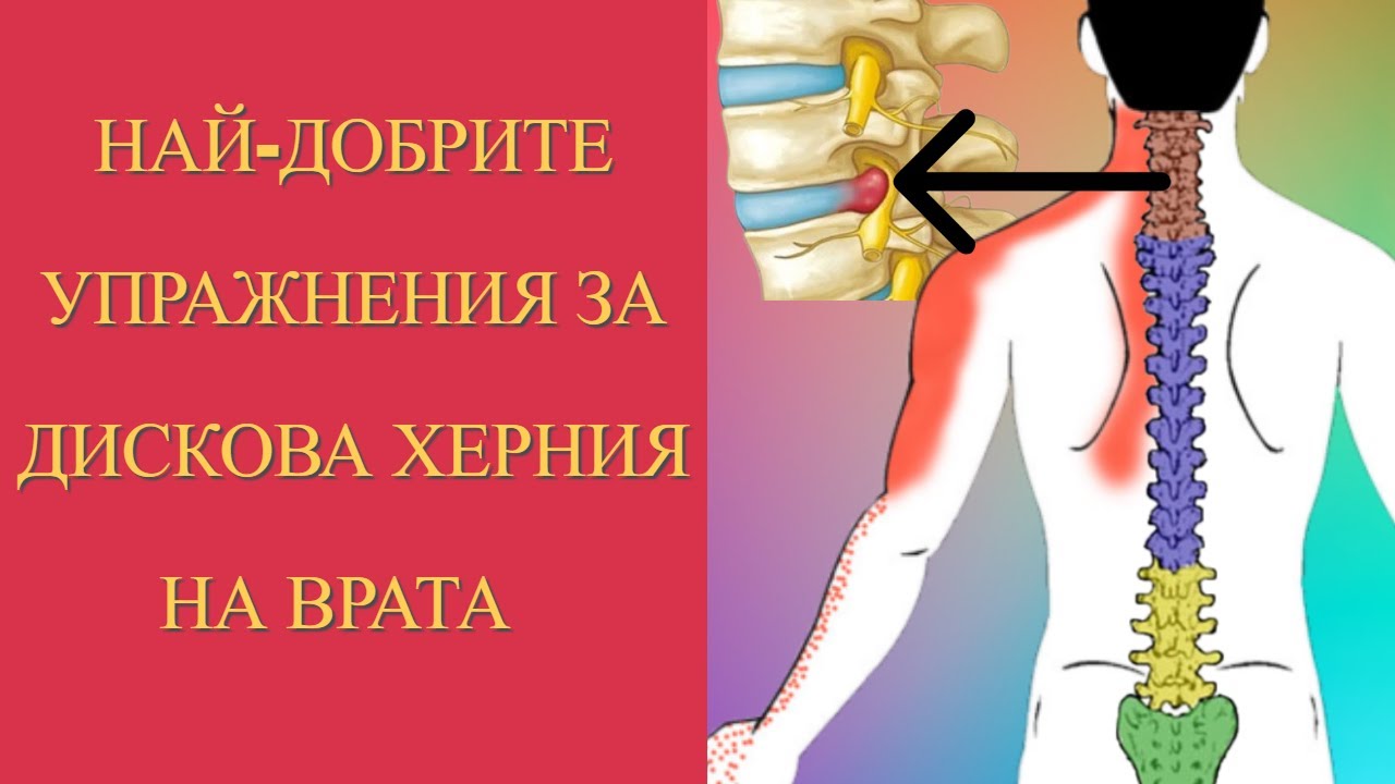 ДИСКОВА ХЕРНИЯ НА ВРАТА От Къде е Изтръпването Съвети От