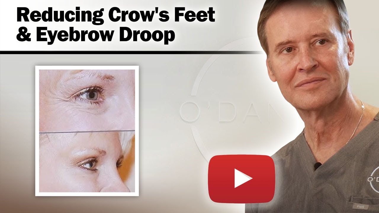 BOTOX for Eyes - Reducing Crow's Feet And Eyebrow Droop - YouTube