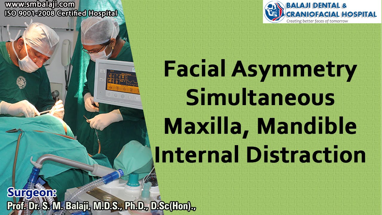 Facial Asymmetry Simultanious Maxilla, Mandible Internal Distraction ...