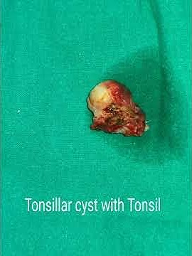 Huge Tonsillar cyst - YouTube