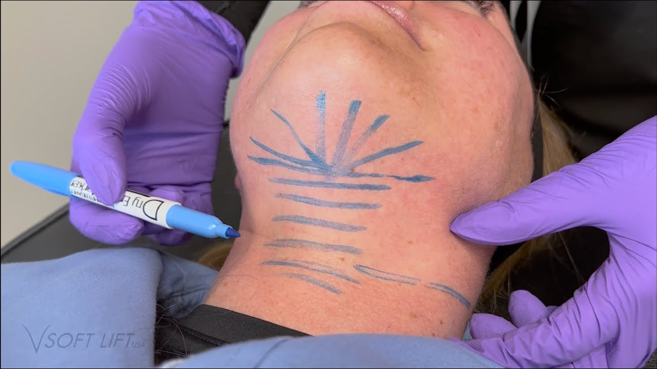 Boost Collagen and Youthful Looks with Vsoft Smooth Threads - YouTube
