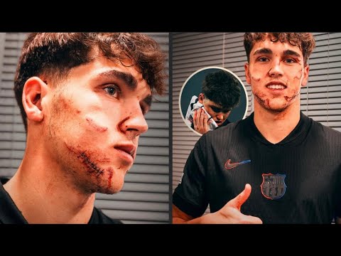 😨🥶Pau Cubarsi's face after the entry and 10 stitches. #PauCubarsi# ...