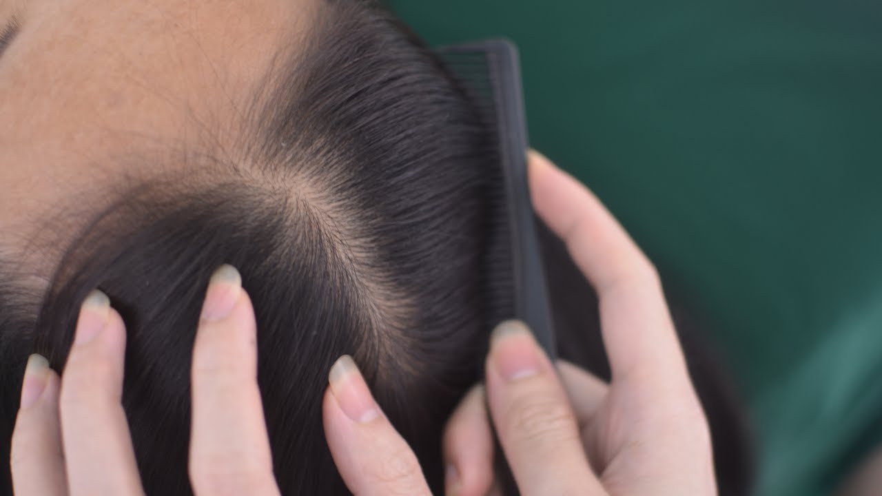 ASMR Scalp Scratching No Talking, Tingles Head Scratching Massage For ...