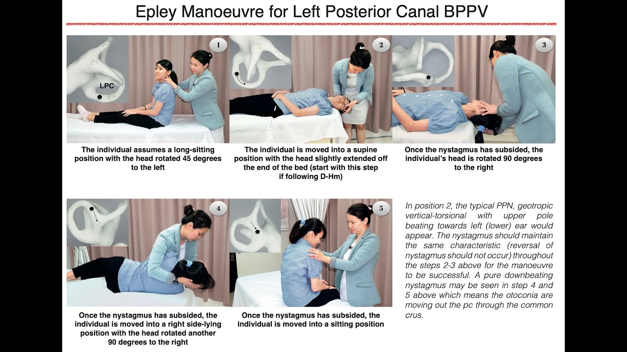 Epley Manoeuvre for Left Posterior Canal BPPV - YouTube