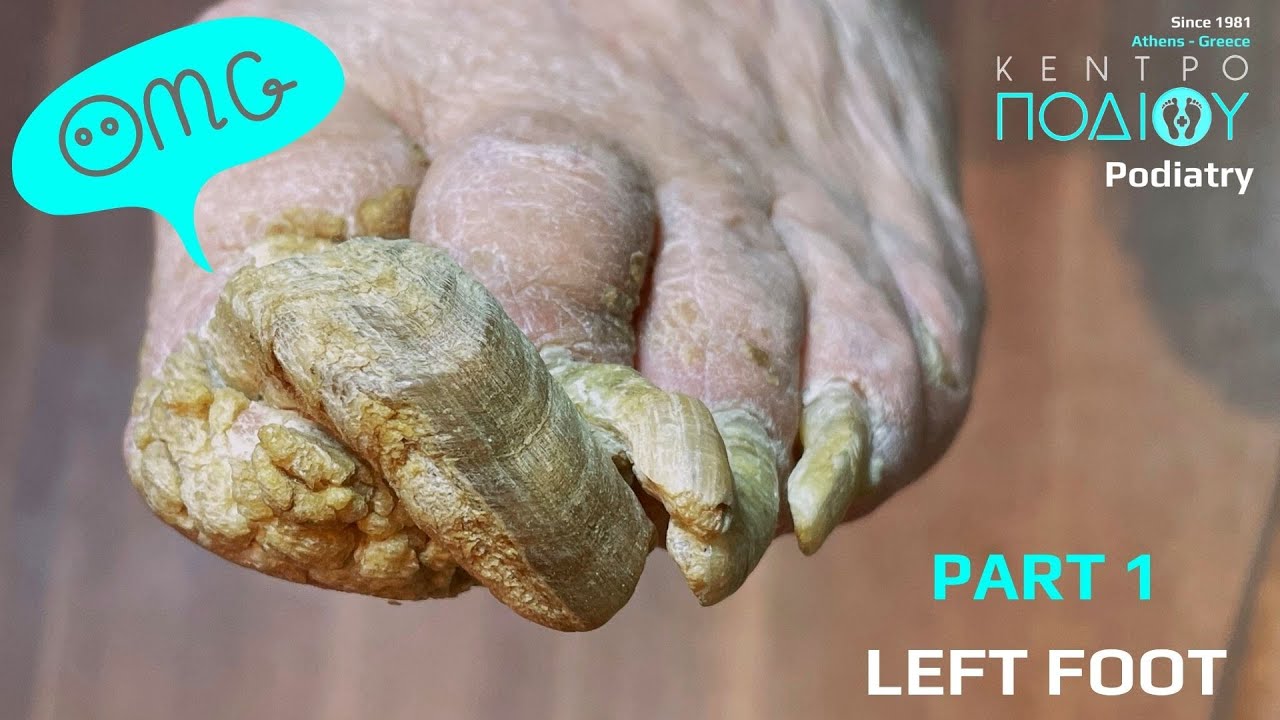 Complicated condition of the nails|Νύχια|Κέντρο Ποδιού Podiatry ...