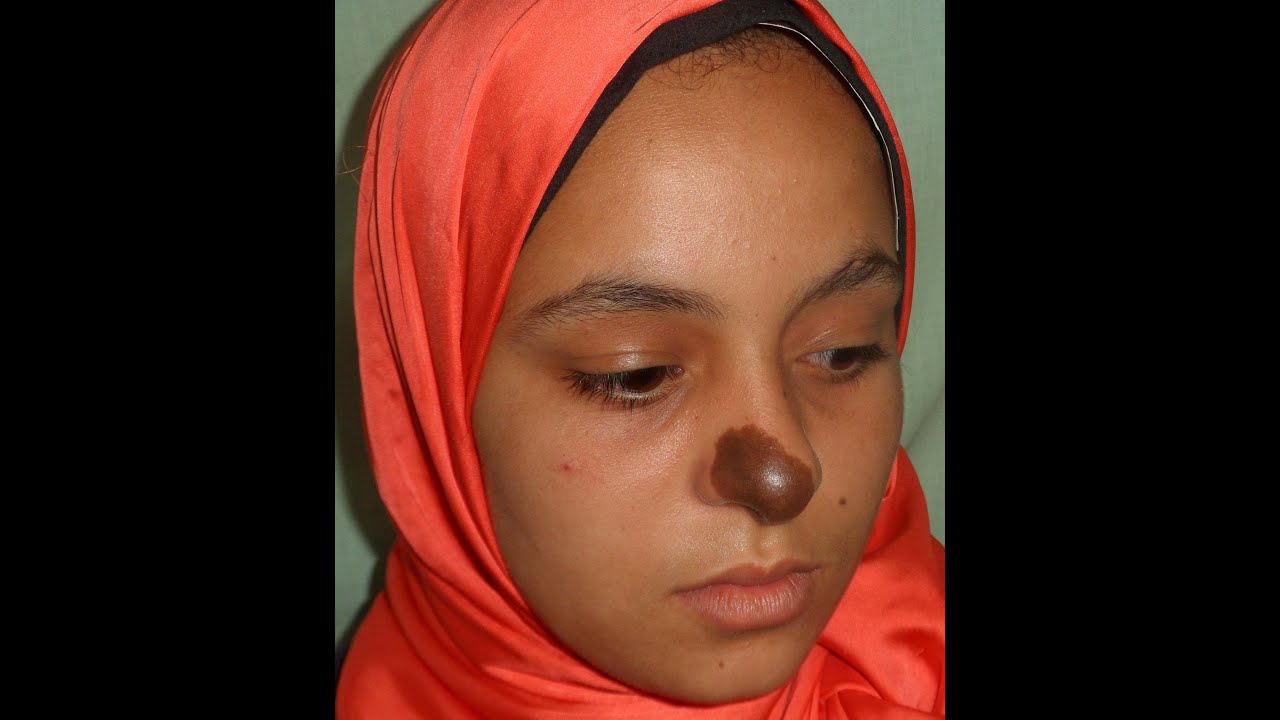 First time in history of medicine removal of CMN wihout surgery by Dr ...