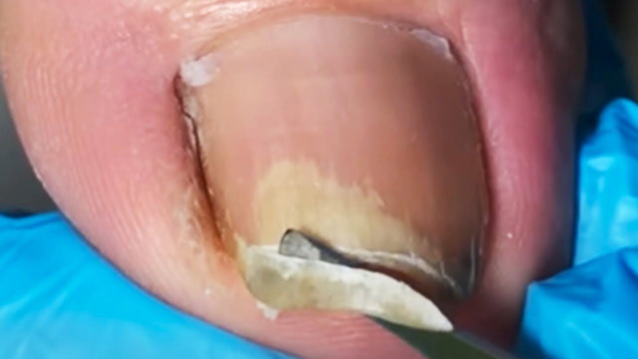 Curly Ingrown Nails Need To Be Trimmed In Time! Avoid Paronychia - YouTube
