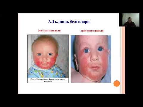 Атопик дерматит - YouTube