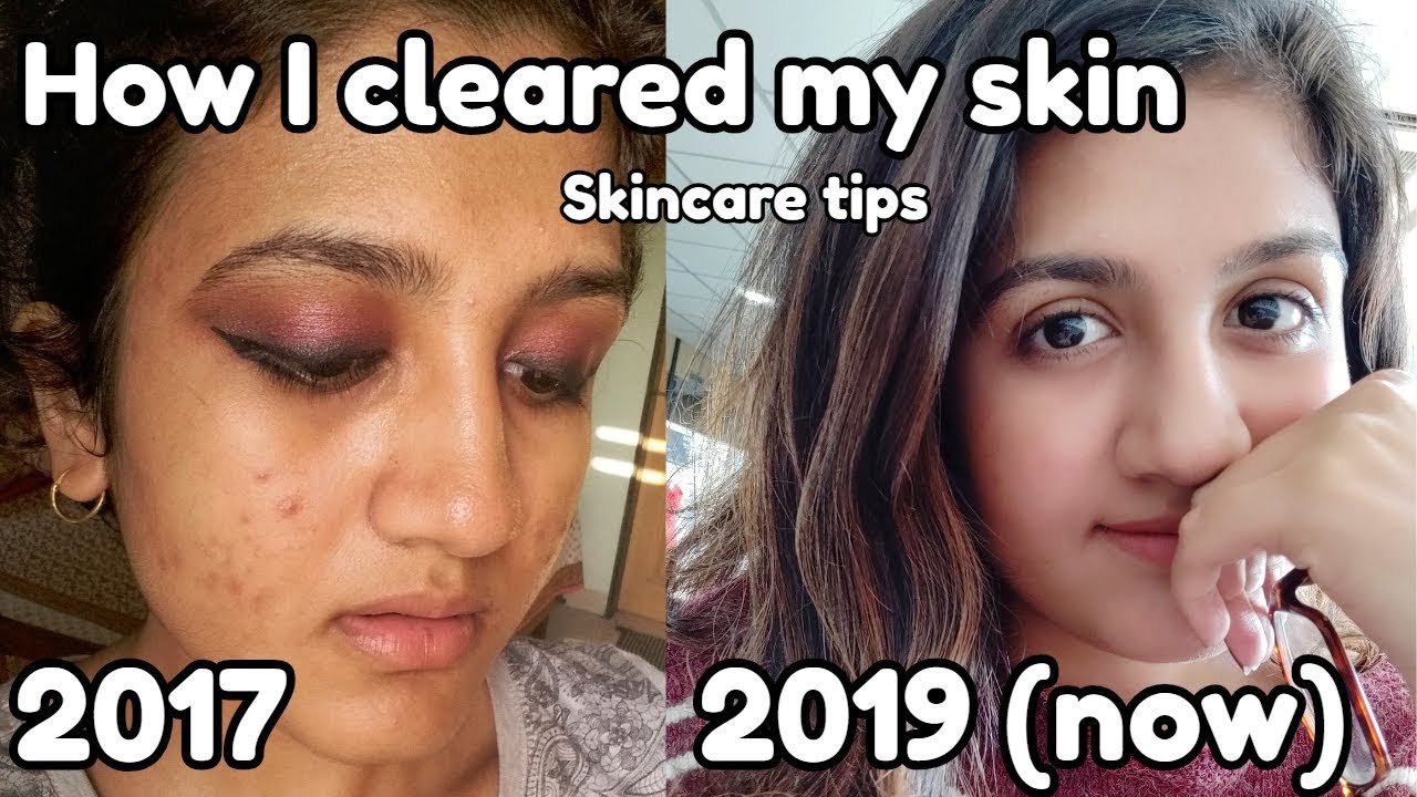 How I Cleared My Skin Skincare Tips Madhushree Joshi Youtube