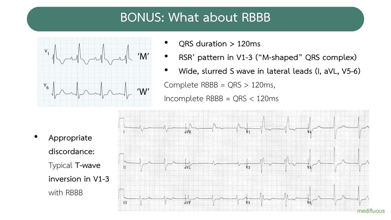 EKG - bonus STEMI, RBBB and ACS - YouTube
