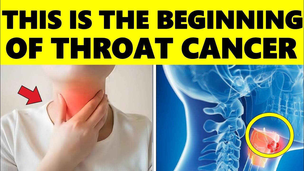 This is How Throat Cancer Starts And NO ONE Tells you – Signs and Symptoms of Throat Cancer ...