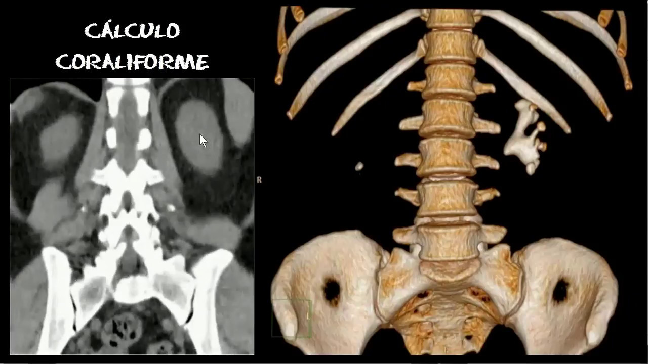 CALCULO RENAL CORALIFORME PDF
