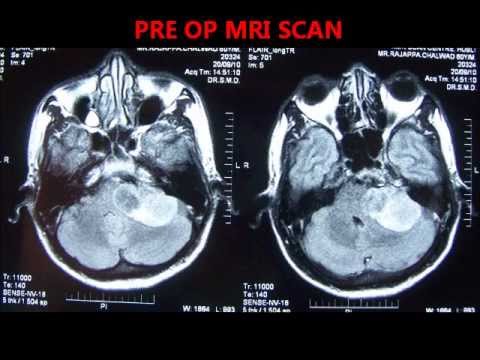 Brain tumor-posterior fossa meningiomas-treatment-images-dr suresh ...
