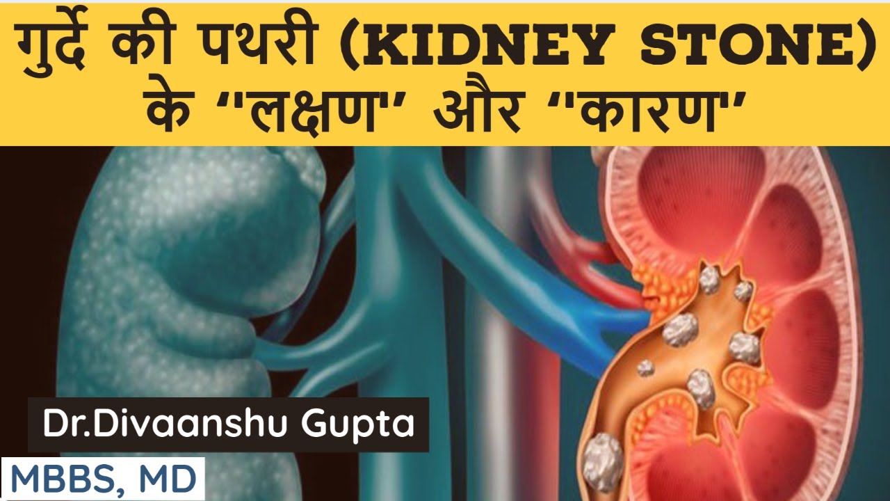 गुर्दे की पथरी के लक्षण ,कारण , Kidney Stone Symptoms Hindi, Kidney ki ...