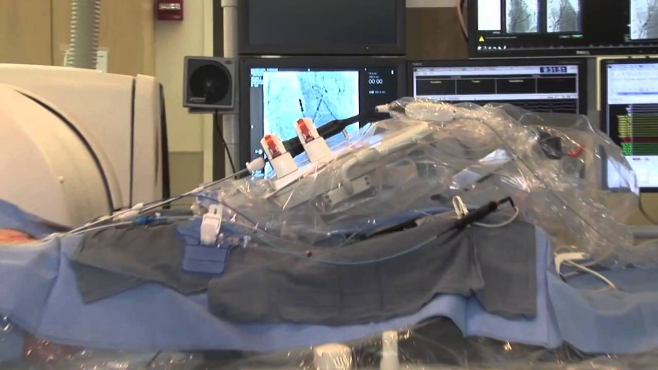 Stereotaxis: Making Huge Difference in Treating Irregular Heartbeats ...