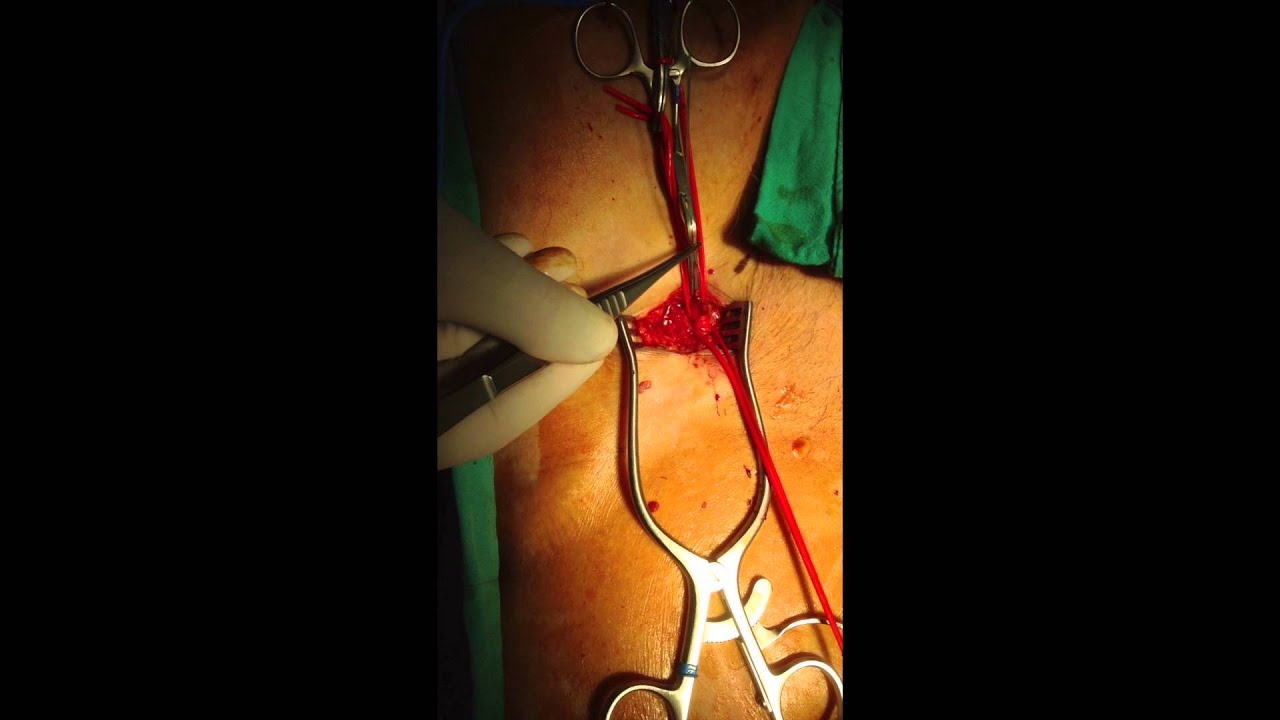 Ep.71 Acute left leg ischemia embolism - YouTube