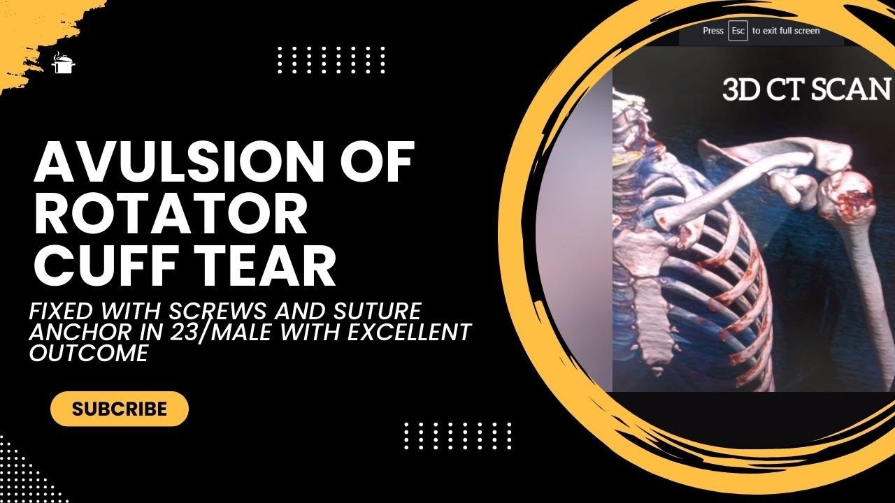 AVULSION OF ROTATOR CUFF TEAR FIXED WITH SCREWS AND SUTURE ANCHOR IN 23 ...