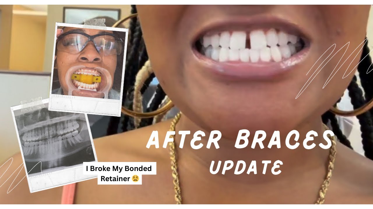 After Braces Update | I BROKE MY BONDED/PERMANENT RETAINER 😫 - YouTube