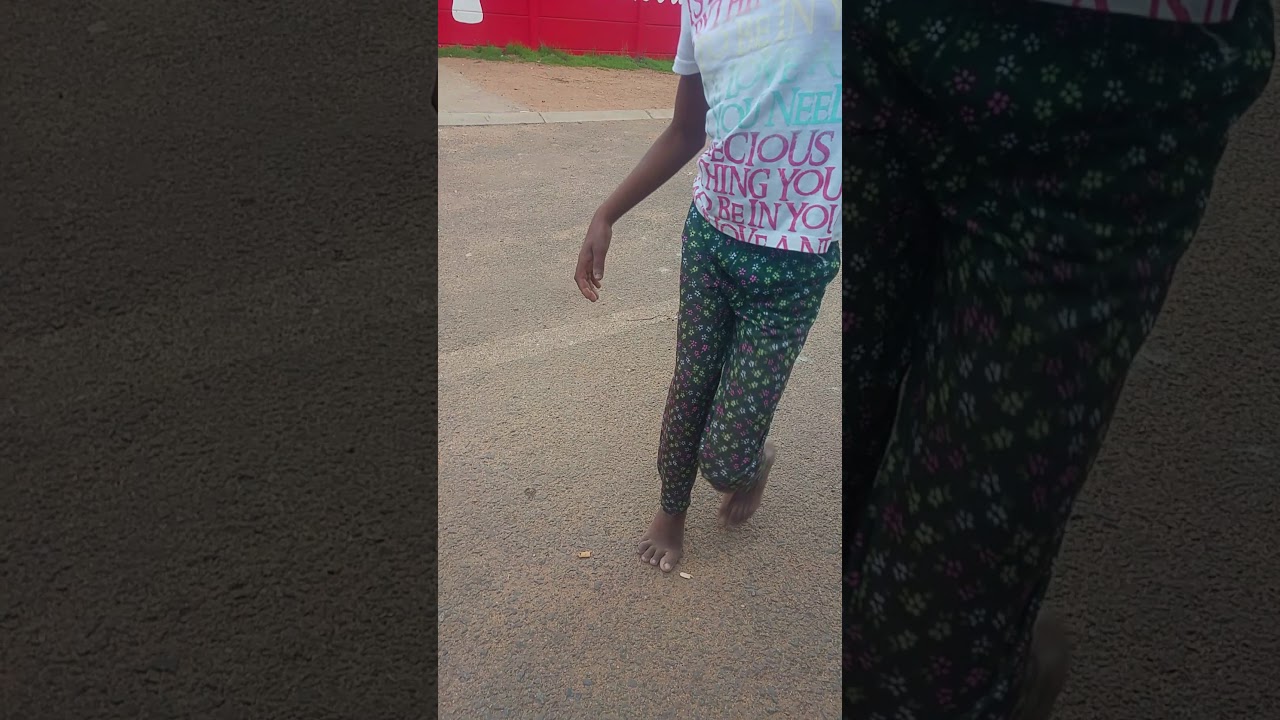 Crippled girl with a deformed short leg 2. - YouTube