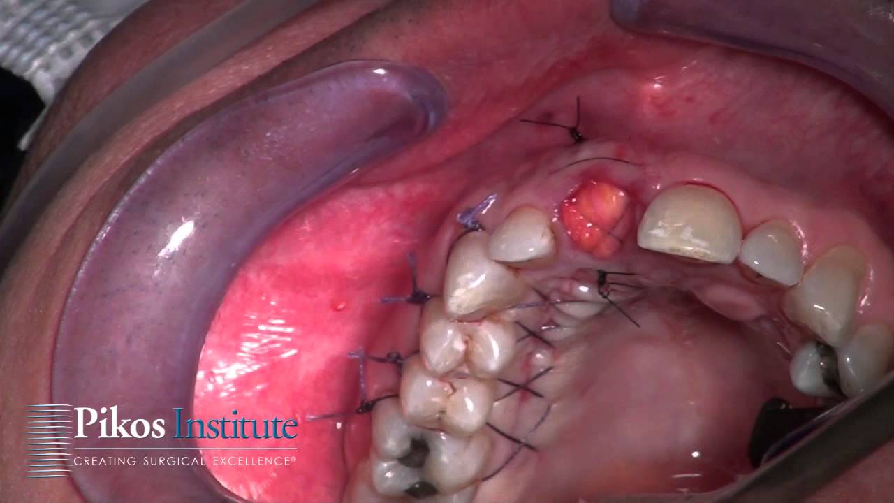 Pikos Implant Institute Soft Tissue Grafting Continuing Education ...