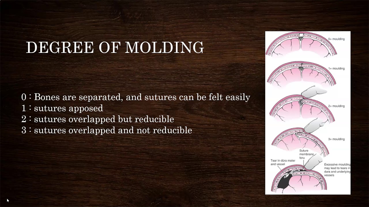 Molding Of Fetal Head By Nadia Naseem YouTube molding-of-fetal-head-by-nadia-naseem-youtube