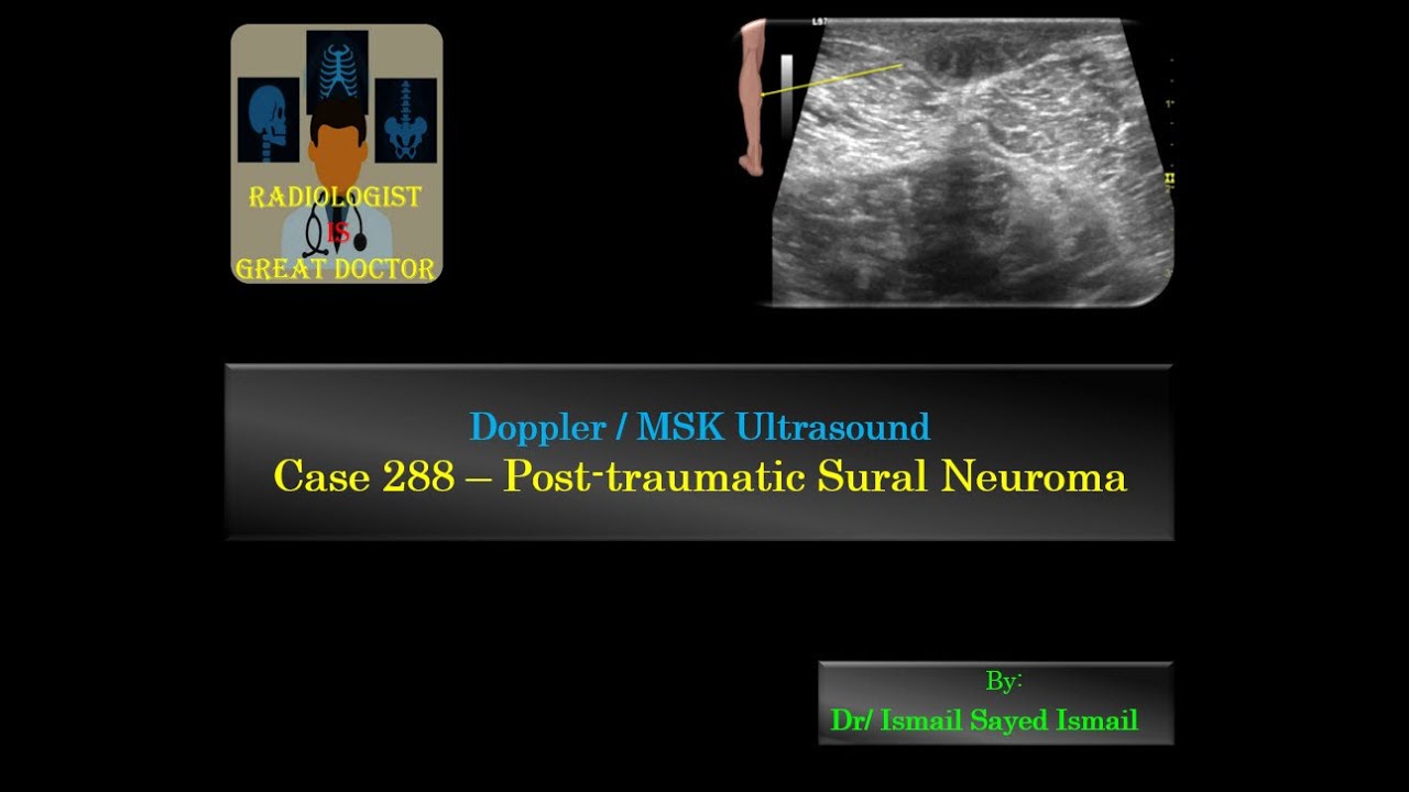 Ultrasound Case 288 - Sural Nerve Traumatic Neuroma - YouTube