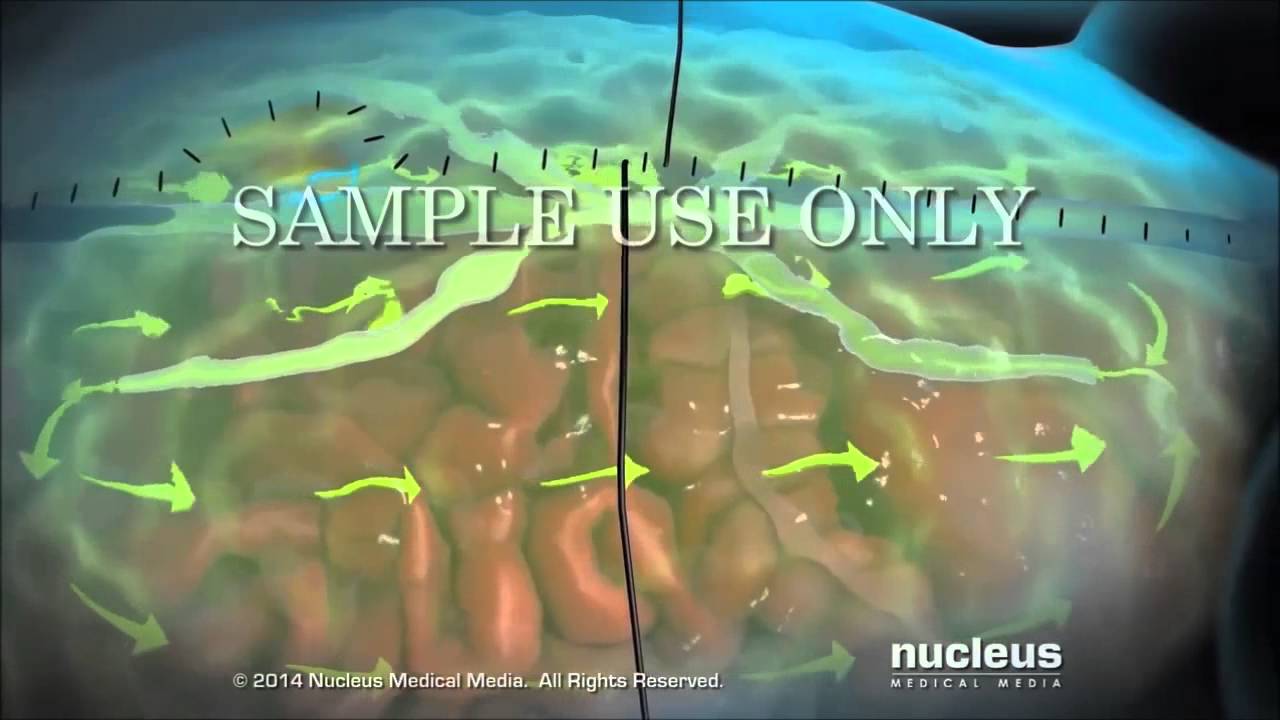 Hyperthermic Intraperitoneal Chemoperfusion