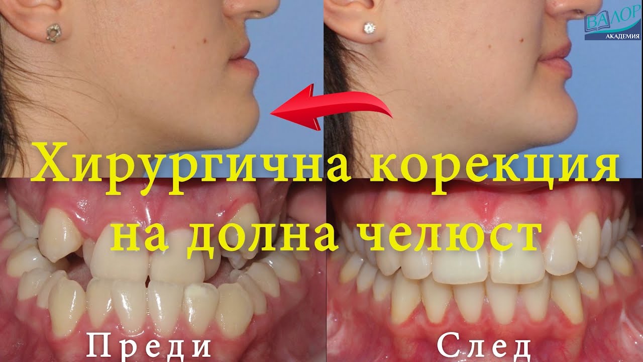 Преразвита долна челюст Преди и След хирургична корекция 4k Youtube