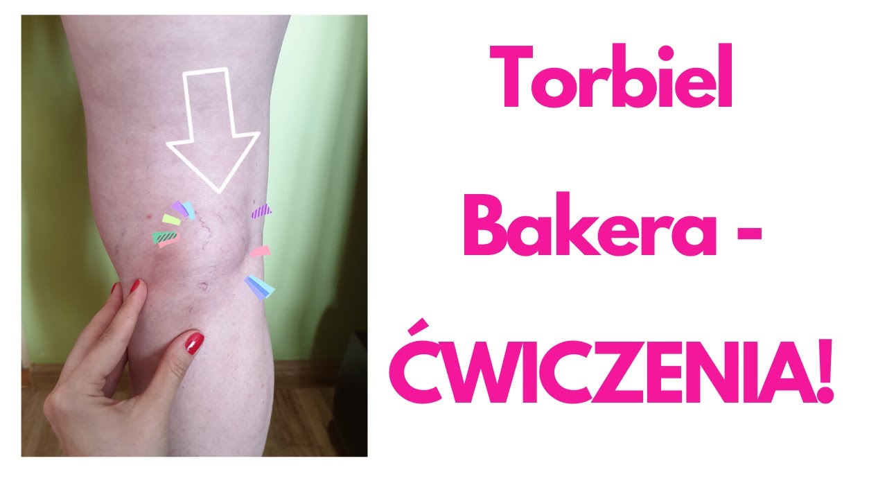 Ćwiczenia cysta Bakera - YouTube