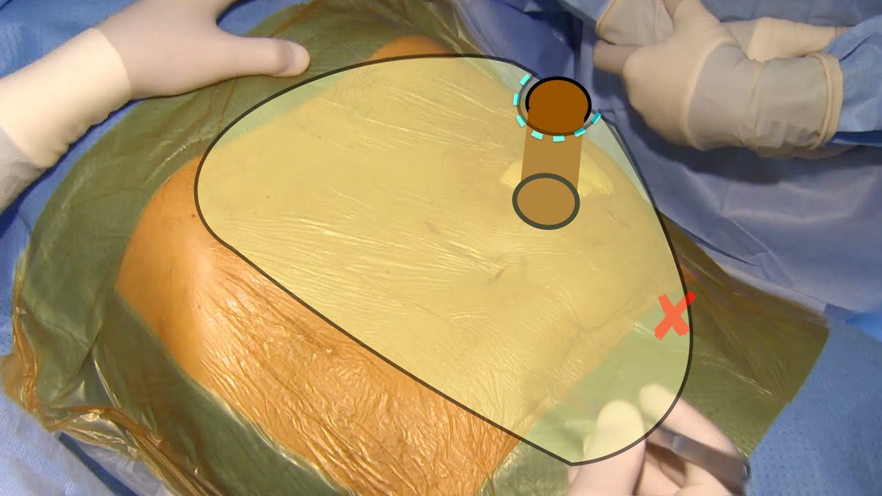 Pauli repair for parastomal EHS type IV - YouTube