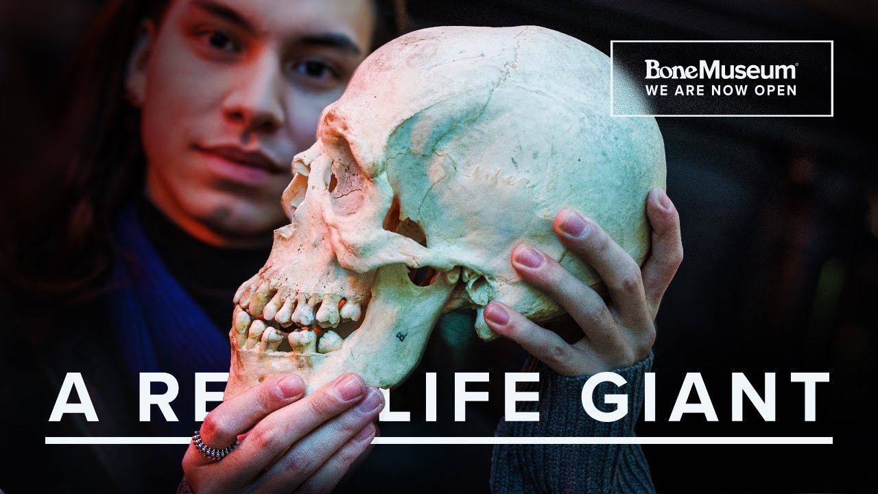 WE HAVE A GIANT? Exploring the Rare Condition of Gigantism | The Bone ...