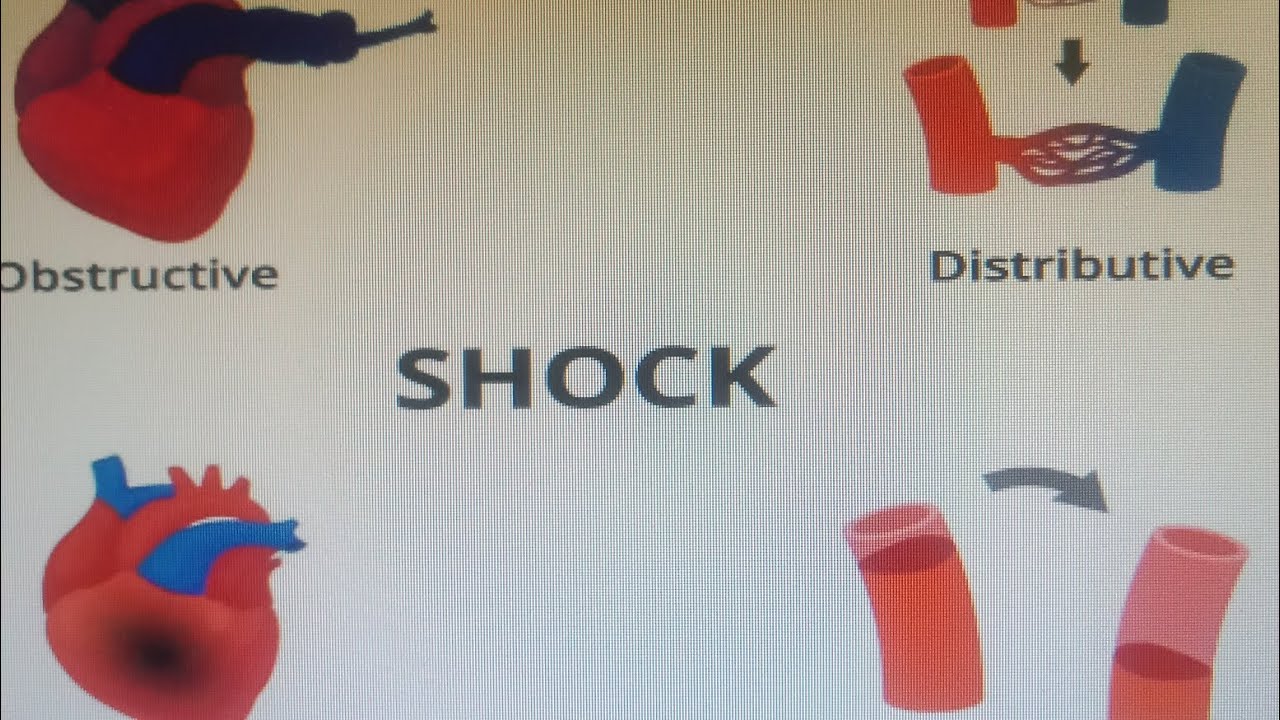 what is shock and symptoms and cause and management #shock #medical # ...